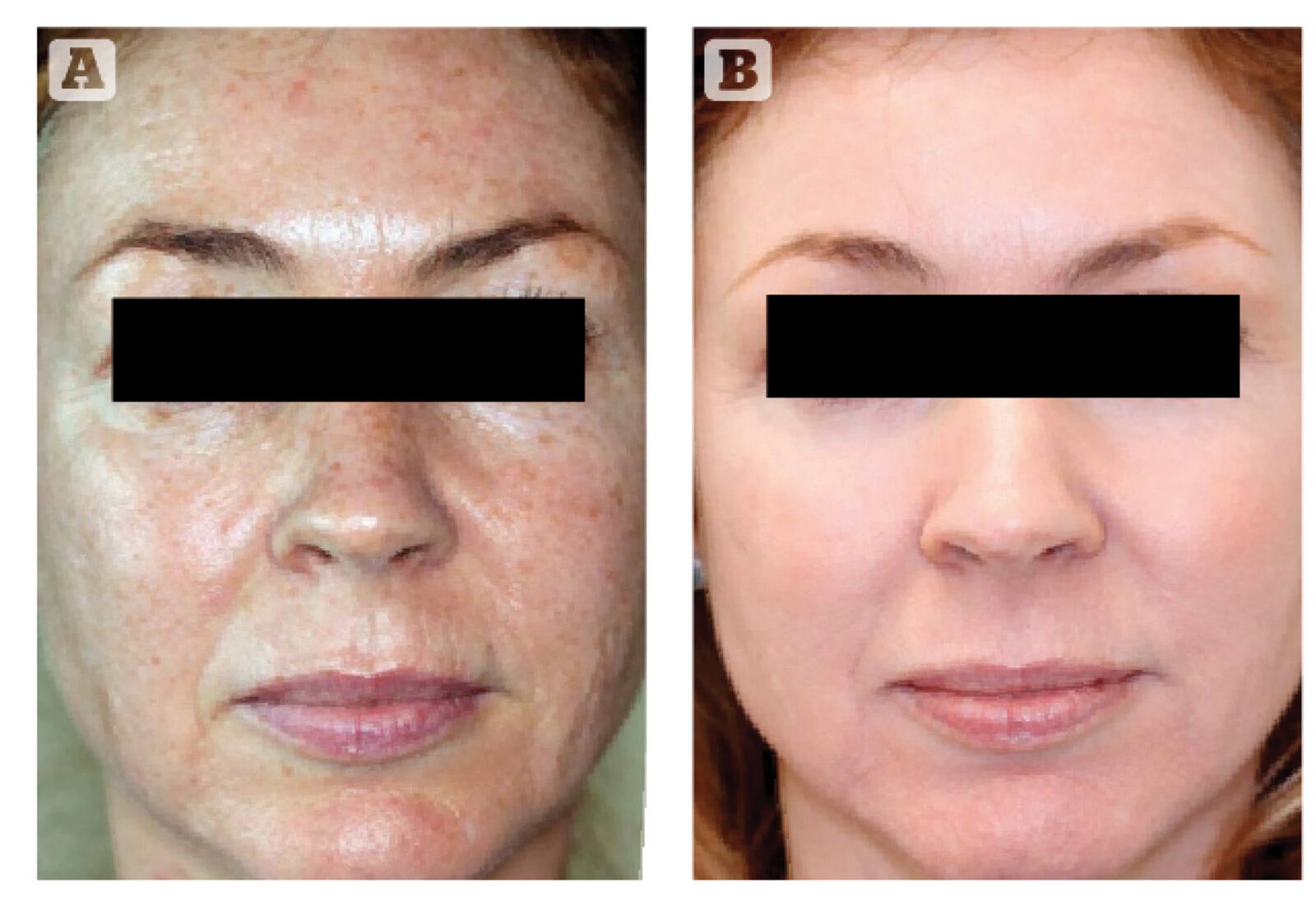 Vitamin A: The superhero of skincare | PRIME Journal