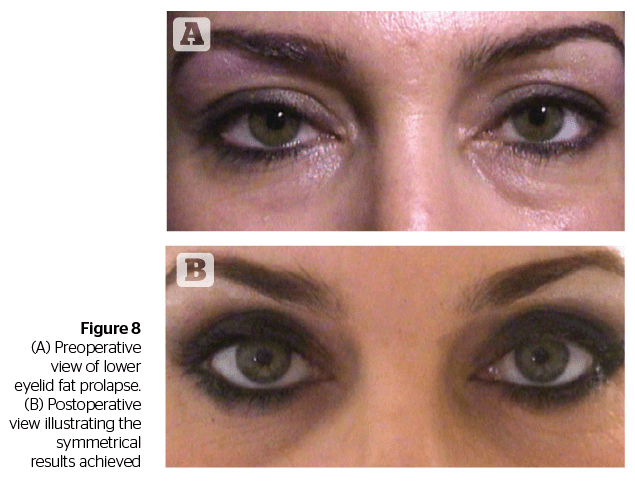 Mini-incision Lower Eyelid Blepharoplasty | PRIME Journal