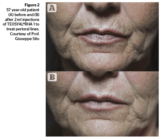 A new filler to treat the perioral area | PRIME Journal