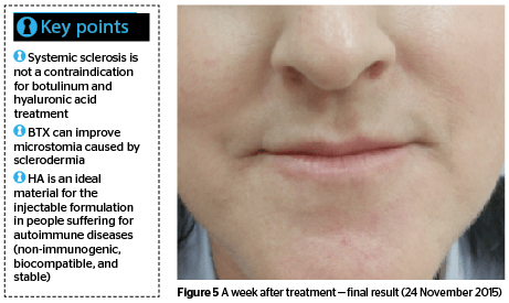 Lip rejuvenation for a patient with Systemic Scleroderma | PRIME Journal