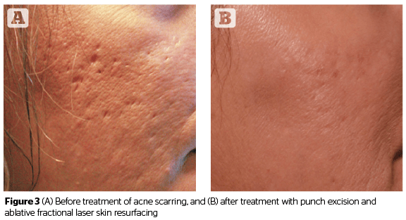 The treatment of acne scars | PRIME Journal