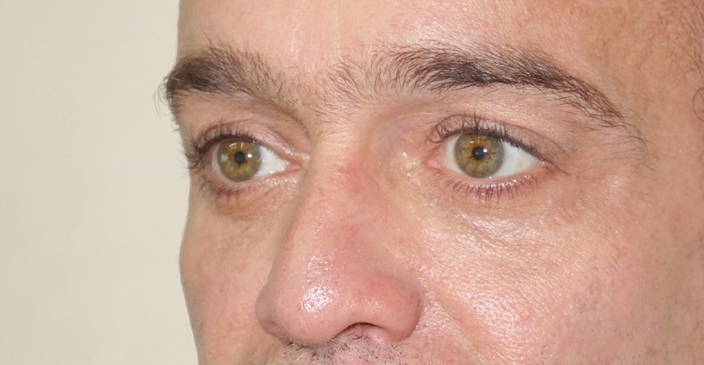 Treating the periorbital region | PRIME Journal