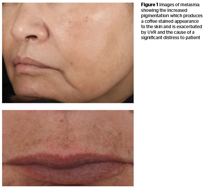Melasma aetiology and treatment review | PRIME Journal