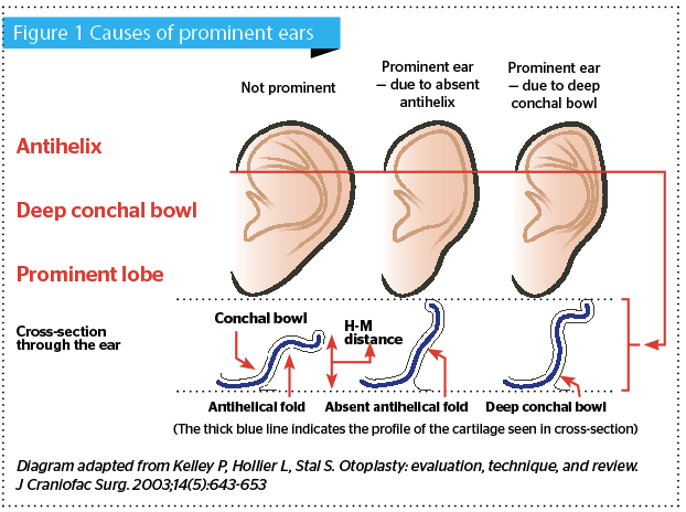 Treating prominent ears with Earfold® | PRIME Journal