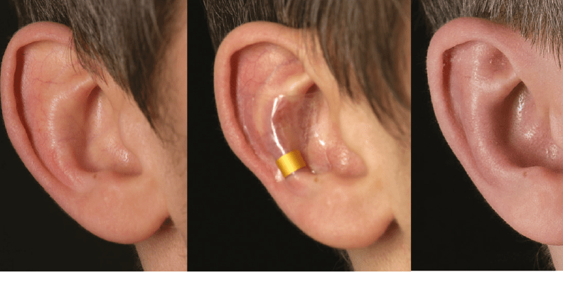 Treating prominent ears with Earfold® | PRIME Journal