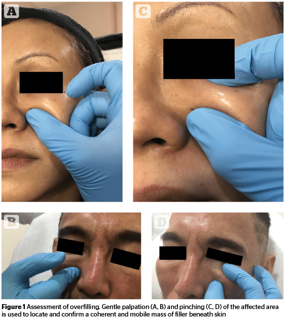 Facial overfilled syndrome complications of inappropriate filler ...